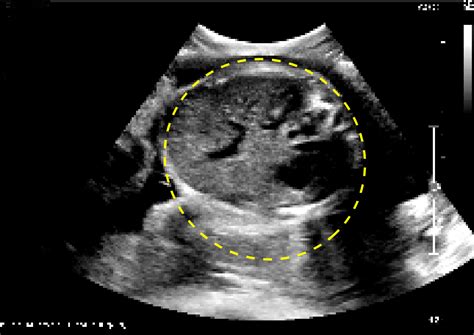 Automatic Estimation Of Fetal Abdominal Circumference From Ultrasound