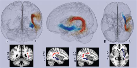 Arcuate Fasciculus Dti