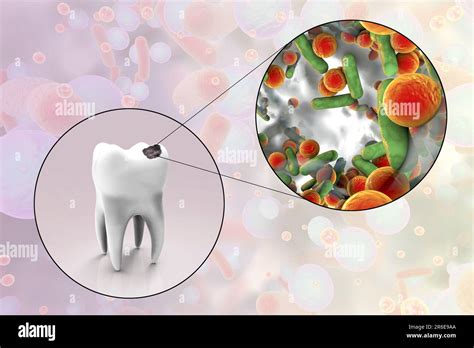 Tooth Decay Computer Artwork Of A Tooth With Cavity And Close Up View