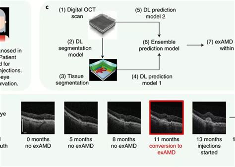 Ai System To Predict Wet Age Related Macular Degeneration Amd Ucl Faculty Of Brain Sciences