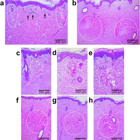 Effect Of 2 MHz Invasive Bipolar RF Treatment Using Non Insulated Download Scientific Diagram