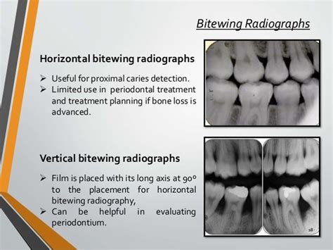 Radiographic Aids In Dx Of Periodontol Ds