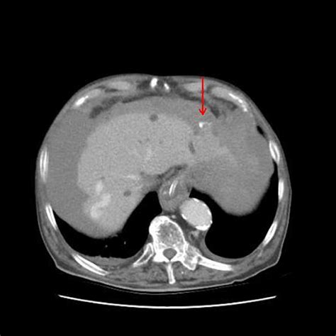 Ct Revealed No Features Of Pulmonary Infection Liver Surface