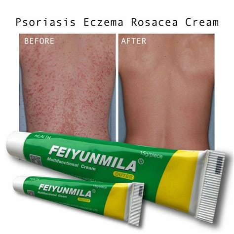 Psoriasis Acne Psoriasis Signs And Symptoms A Comprehensive Guide To