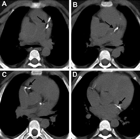 Chest CT Of Patient 2 A And B Dense Calcification In The Left Download Scientific Diagram