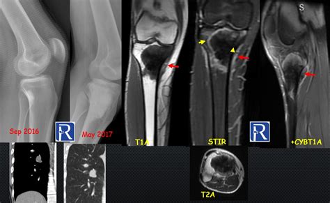 Conventional Osteosarcoma With Lung Metastasis