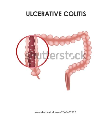 Ulcerative Colitis Colon Medical Vector Illustration Stock Vector