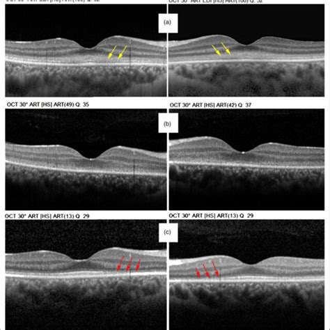 Macular Oct Of The Right And Left Macula A Initial Presentation Download Scientific Diagram