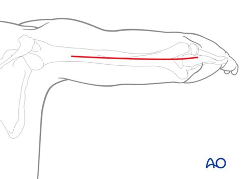 Orif Plate Fixation Distal 1 3 For Multifragmentary Fracture Intact Segment