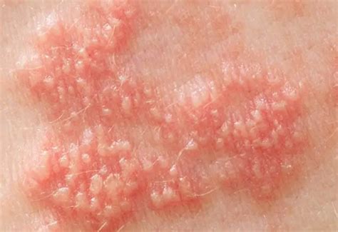 Nhiễm Herpes Simplex Triệu Chứng Nguyên Nhân Và điều Trị