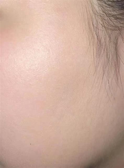 痘印要多久才能去掉 知乎