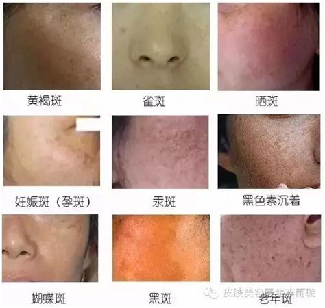 色素沉着的发病原因及临床治疗 搜狐健康