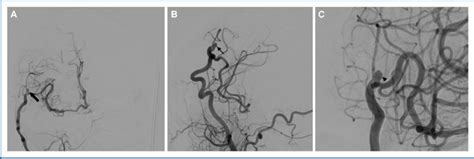 A Angiogram Demonstrates Patency Of The Sta Mca Bypass And An Aneurysm