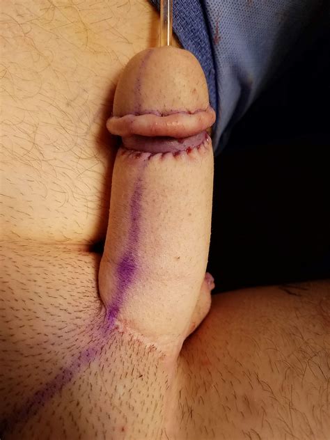 Photos Glansplasty Mang Chen Gurecon