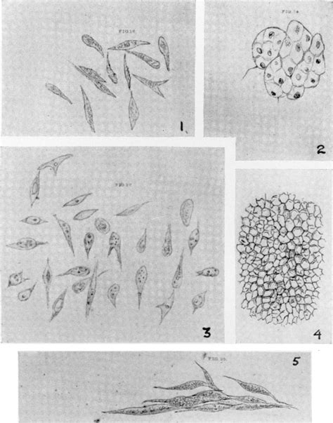 Figure 1 From Johannes Müller And The Modern Conception Of Cancer