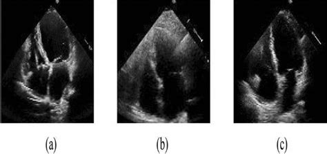 Cardiac Phase Detection In Echocardiography Using Convolutional Neural Eric Feuilleaubois Phd