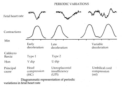 Categorization Of Fetal Heart Rate Decelerations In American And