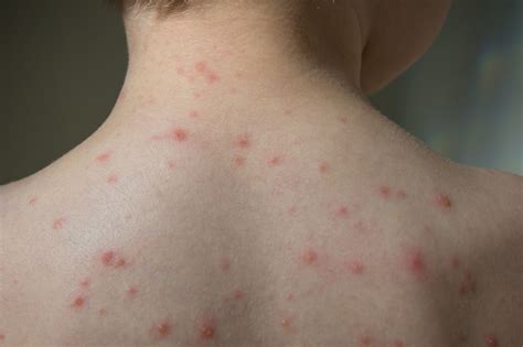 Chicken Pox Virus Chickenpox What Is It Why Is It Spreading At The