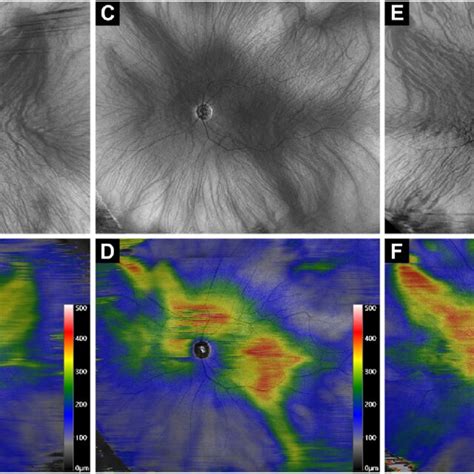 Representative Cases Of Choroidal Venous Congestion Patterns On En Face