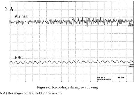 Structure Of Thyrohyoid Ligament Semantic Scholar