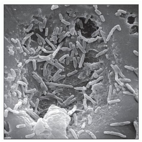 Atypical Mycobacterial Lymphadenitis Basicmedical Key