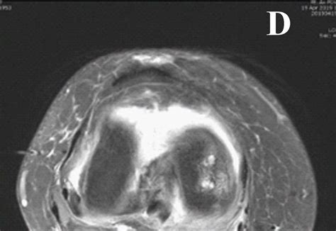 Quantitative Measurement In Knee Joint Effusion Correlation Between