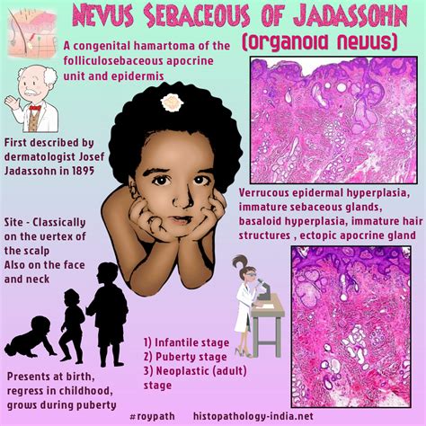 Pathology Of Nevus Sebaceus Of Jadassohn Pathology Sebaceous Gland