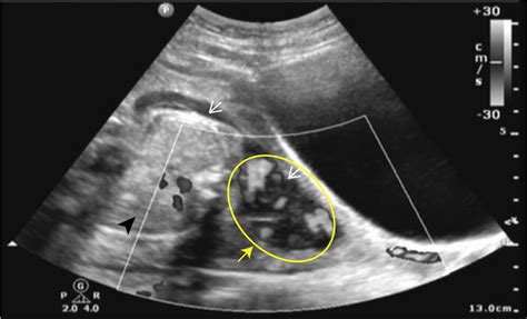 Obstetric Ultrasonography After Admission There Is Hardly Any Amniotic