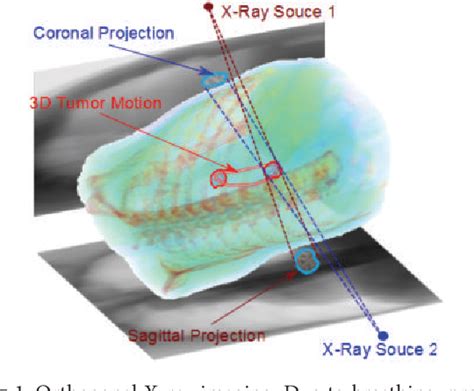 Figure 1 From Tracking Lung Tumors In Orthogonal X Rays Semantic Scholar