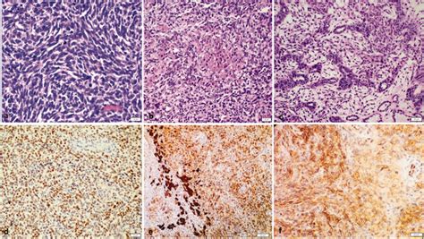 Mixed Sex Cordstromal Tumor Gynandroblastoma With Malignant