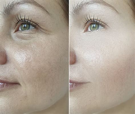 Woman Face Wrinkles Before And After Dermatology Removal Treatment Stock Image Image Of Effect
