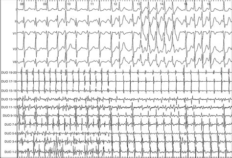 Flutter Auricular 1 1 Tras La Administración De Vernakalant Para Cardioversión De Fibrilación