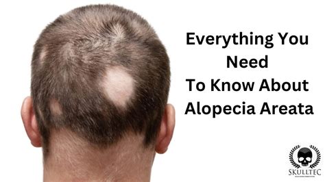 Alopecia Areata Solutions Boost Confidence With SMP