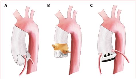 Outcome Comparison Of Different Approaches To Aortic Root Aneurysm