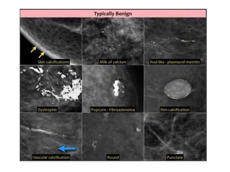 Mmg Calcification Types Awesome Slides On Bc Mastitis Lymph