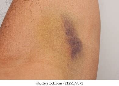 36 Iv Bruise Images Stock Photos Vectors Shutterstock