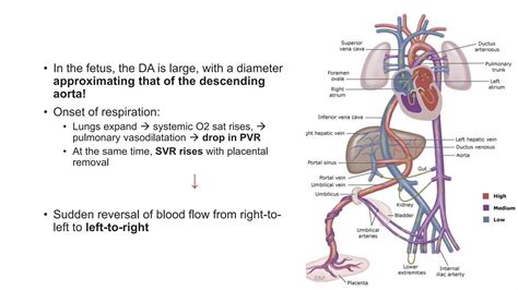 Patent Ductus Arteriosus Pda Echocardiographic Assessment Anatomy