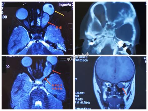 视神经胶质瘤 脑医汇