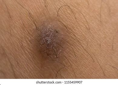 Close Keloid Scar Hypertrophic Scar On Stock Photo 1155459907