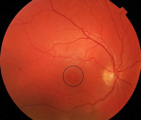 Can Laser Damage Eyes At Brook Short Blog