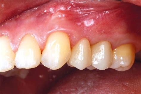 Ridge Reconstruction With Maxgraft® Block In The Posterior Maxilla Botiss Biomaterials Gmbh
