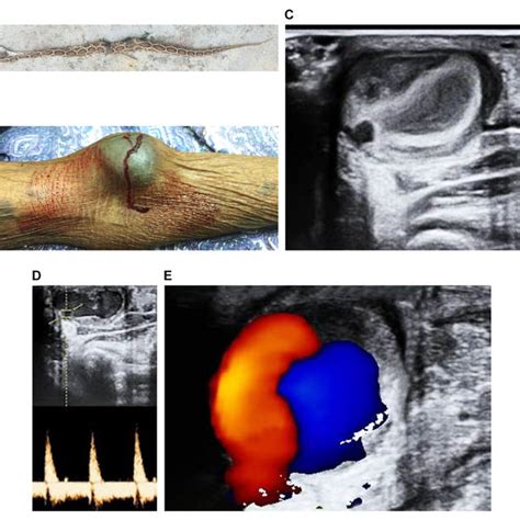 Pdf Ultrasound Guided Compression Method Effectively Counteracts Russells Viper Bite Induced