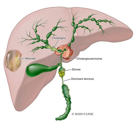 Mayo Clinic Comprehensive Cancer Center On Twitter Jaundice White Colored Stools Fatigue And