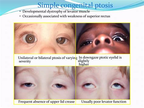 Ptosis Pptx
