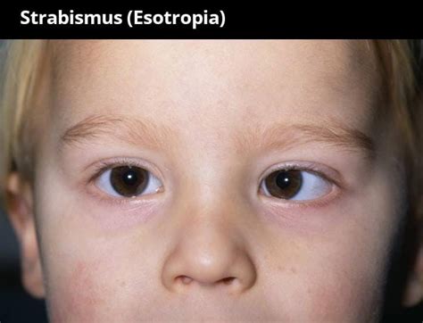 Esotropia Optography