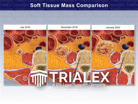 Soft Tissue Mass Comparison Trialquest Inc