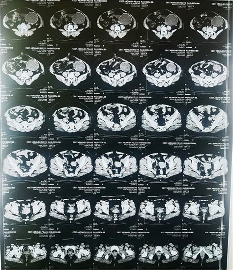 Shows Ct Scan Image Of The Duplication Cysts Blue Arrows For