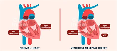 Ventricular Septal Defect Surgery In India Cost Best Doctors And Top