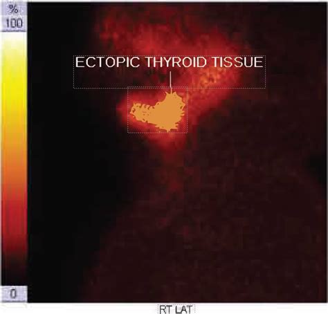 Lingual Thyroid Best Multispeciality Hospital In Mumbai India Kokilaben Hospital