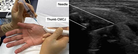 Thumb Arthritis Injection Thumb Base Cmc Joint Steroid Injection